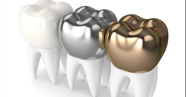 Choosing Between Metal and Porcelain Crowns - Austin Dental Center